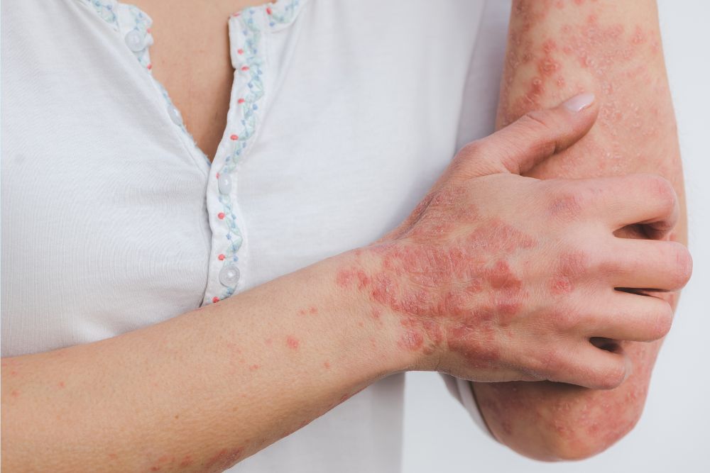 Ontstekingen centraal bij psoriasis - Medisch Dossier